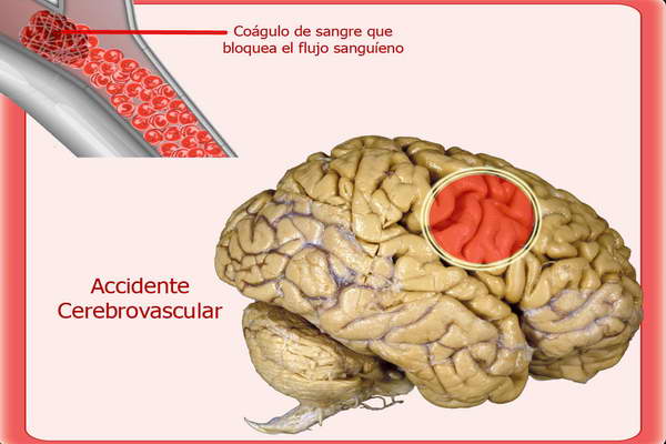 En un Accidente Cerebro Vascular Cada Segundo Cuenta | Region2.cl